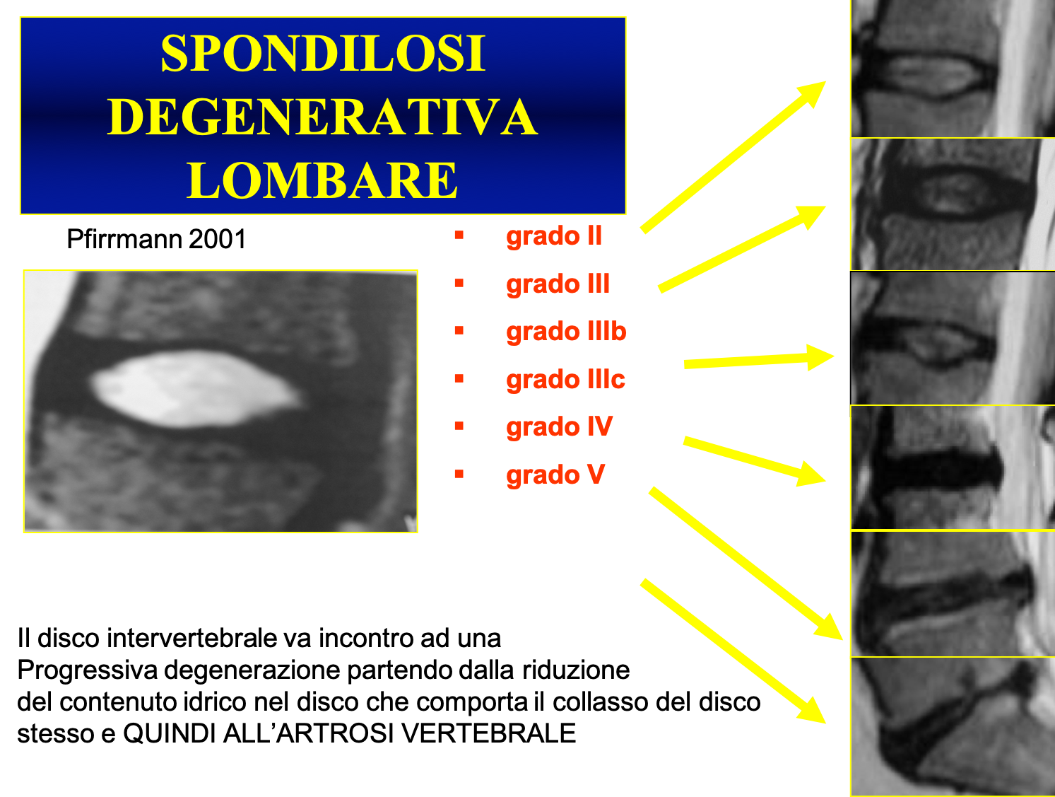 Patologie degenerative del disco intervertebrale lombare – dott. Matteo ...