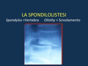 La Spondilolisi e Spondilolistesi – dott. Matteo Palmisani