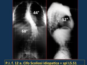 La Spondilolisi e Spondilolistesi – dott. Matteo Palmisani